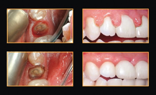 SAPPHIRE PORTABLE LASER 808NM 5W | DENMAT # LR1001W | US Dental Depot