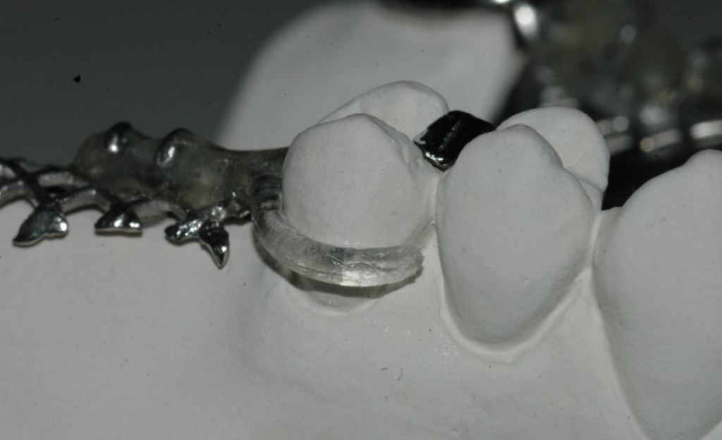 ITSOCLEAR CLASPS MOLAR | KEYSTONE # 1009151 | US Dental Depot