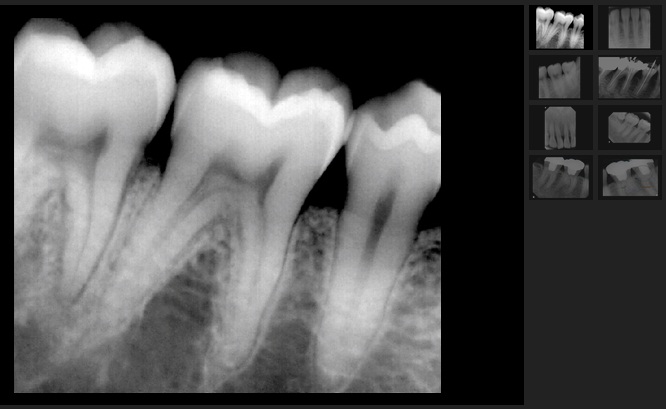 ZEN-PX2 PORTABLE X-RAY | GENORAY # PORT X II | US Dental Depot